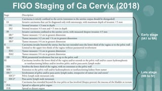 Treatment of Advanced stage of Carcinoma Cervix & Ca cervix in ...