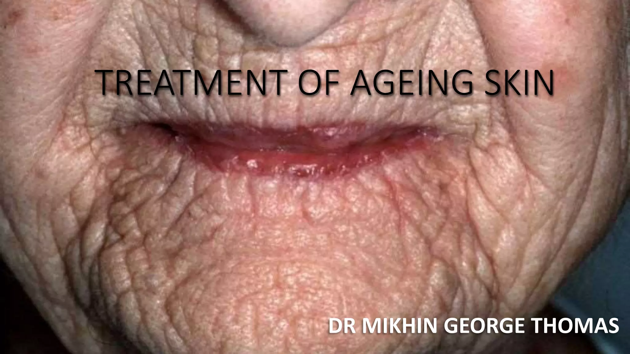 Treatment of ageing skin | PPTX