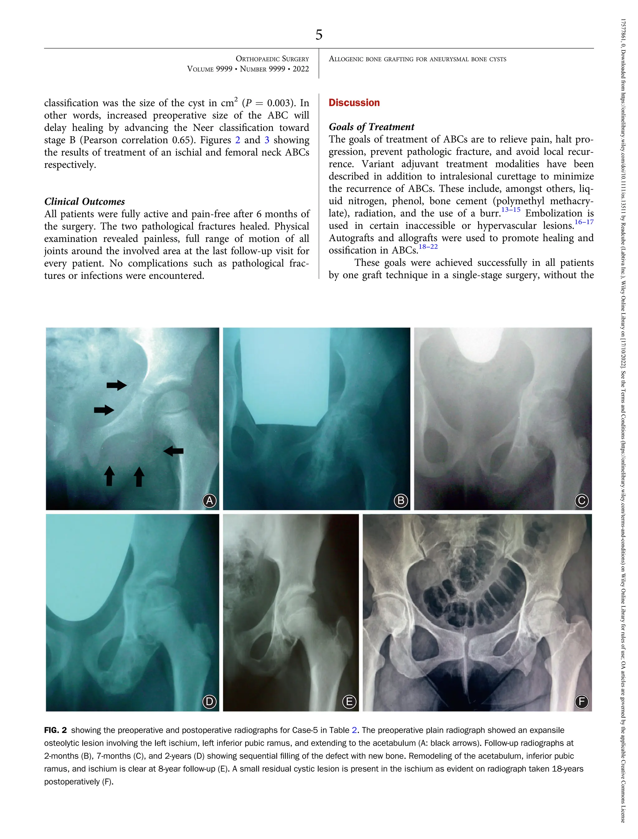 Treatment of Aneurysmal Bone Cysts by Minimally Invasive Curettage and ...