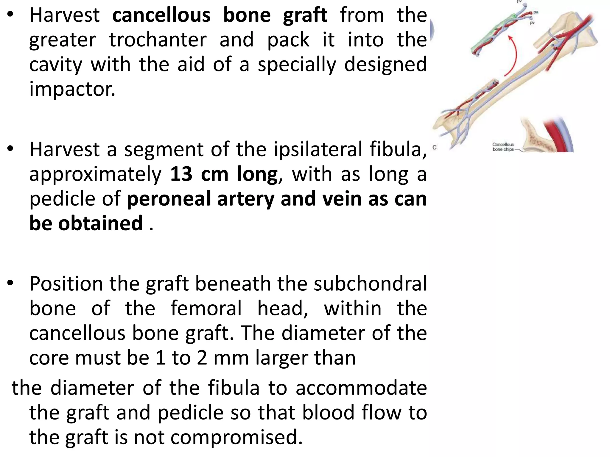 Treatment of avn of femoral head | PPTX