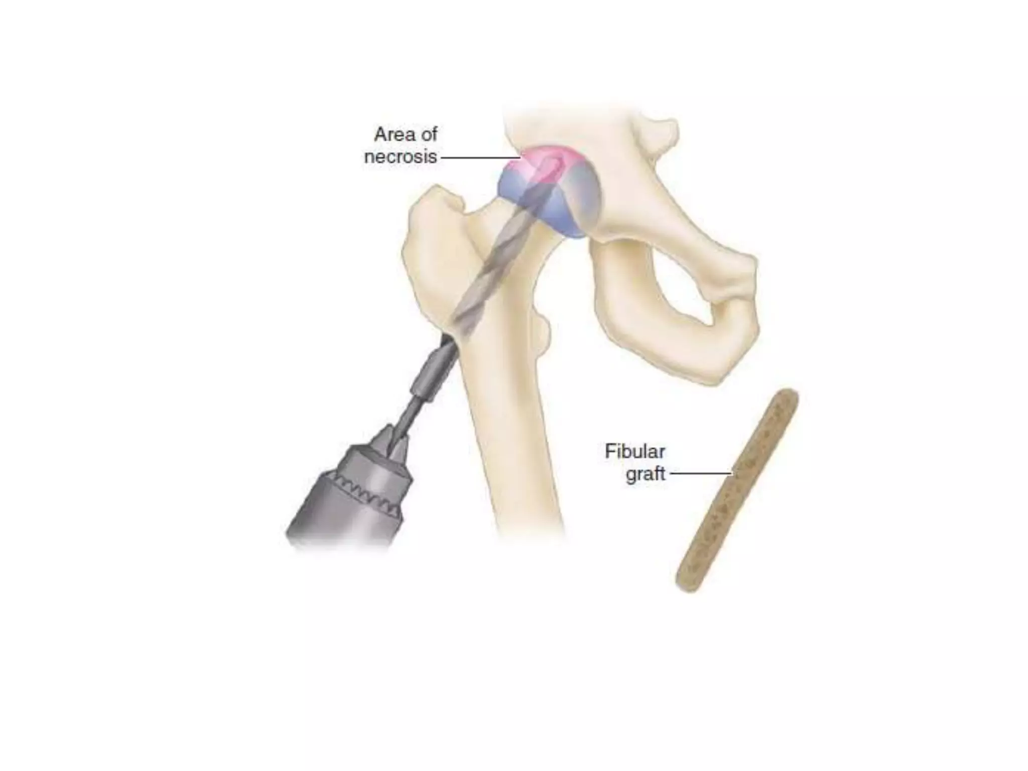 Treatment of avn of femoral head | PPTX