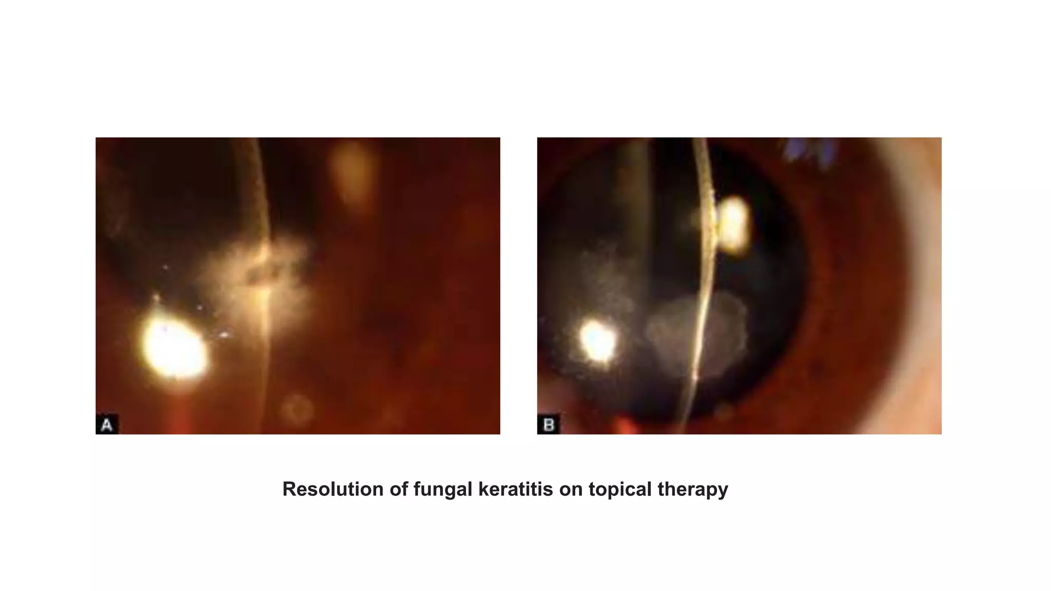 GLUE and Treatment of bacterial n fungal corneal ulcer | PPT