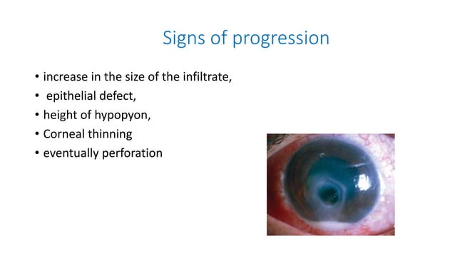 Glue And Treatment Of Bacterial N Fungal Corneal Ulcer Ppt