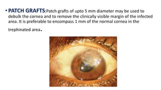 GLUE and Treatment of bacterial n fungal corneal ulcer | PPTX
