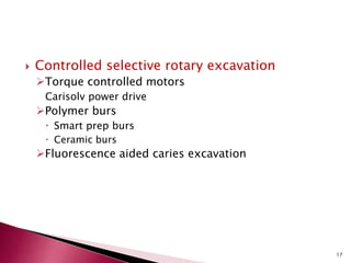 Treatment of caries - SHINY MOUNICA.P | PPTX