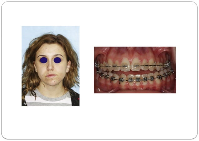 Treatment of Chronic Mandibular Hypomobility and Growth Disorders.pptx