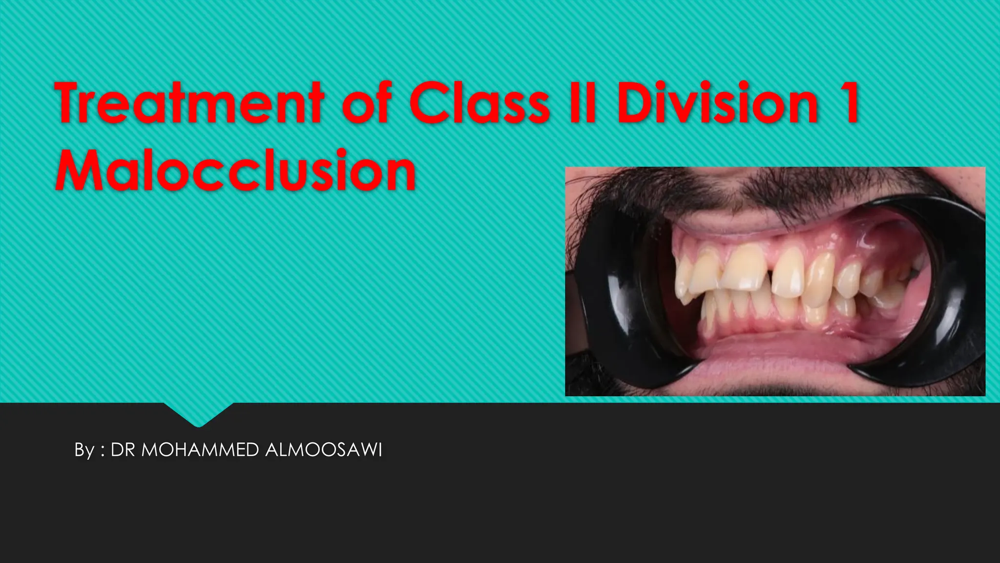 Treatment of Class II Division 1 Malocclusion.pptx