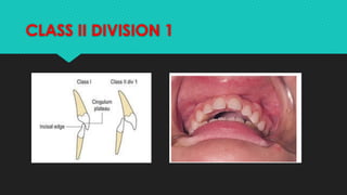 Treatment of Class II Division 1 Malocclusion.pptx