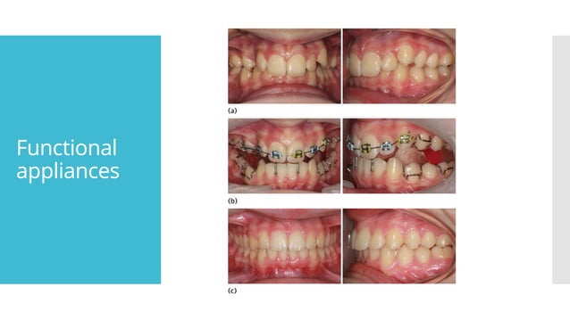 Treatment Of Class Ii Division 2 Malocclusion Pptx