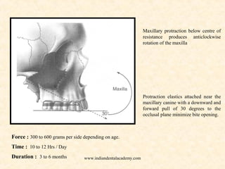 Treatment of class 3 malocclusion | PPT