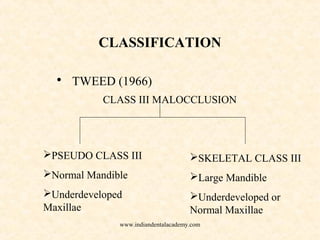 Treatment of class 3 malocclusion | PPT
