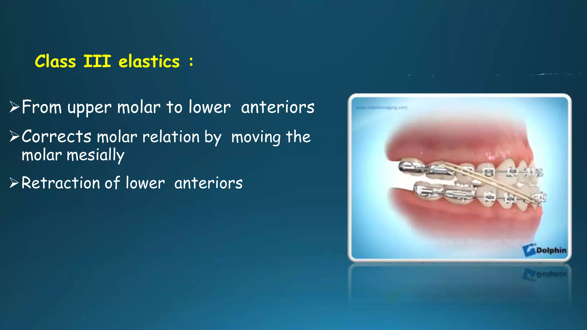 Treatment of class iii malocclusion | PPTX