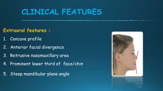 Treatment of class iii malocclusion | PPTX