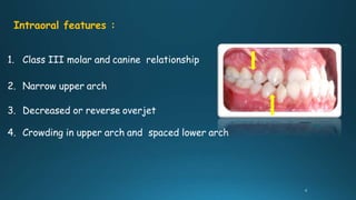 Treatment of class iii malocclusion | PPTX