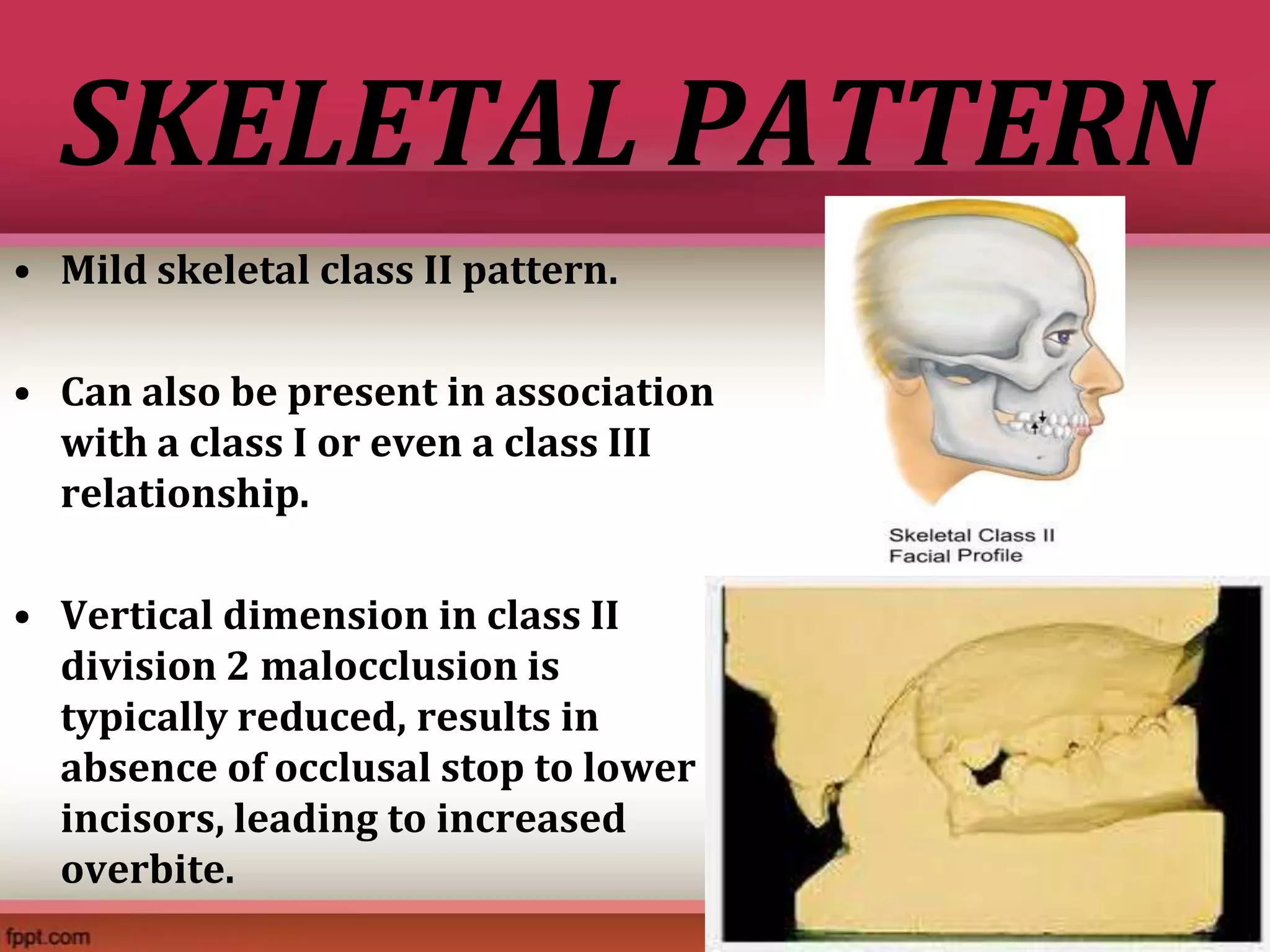 Treatment of class ii malocclusions | PPTX