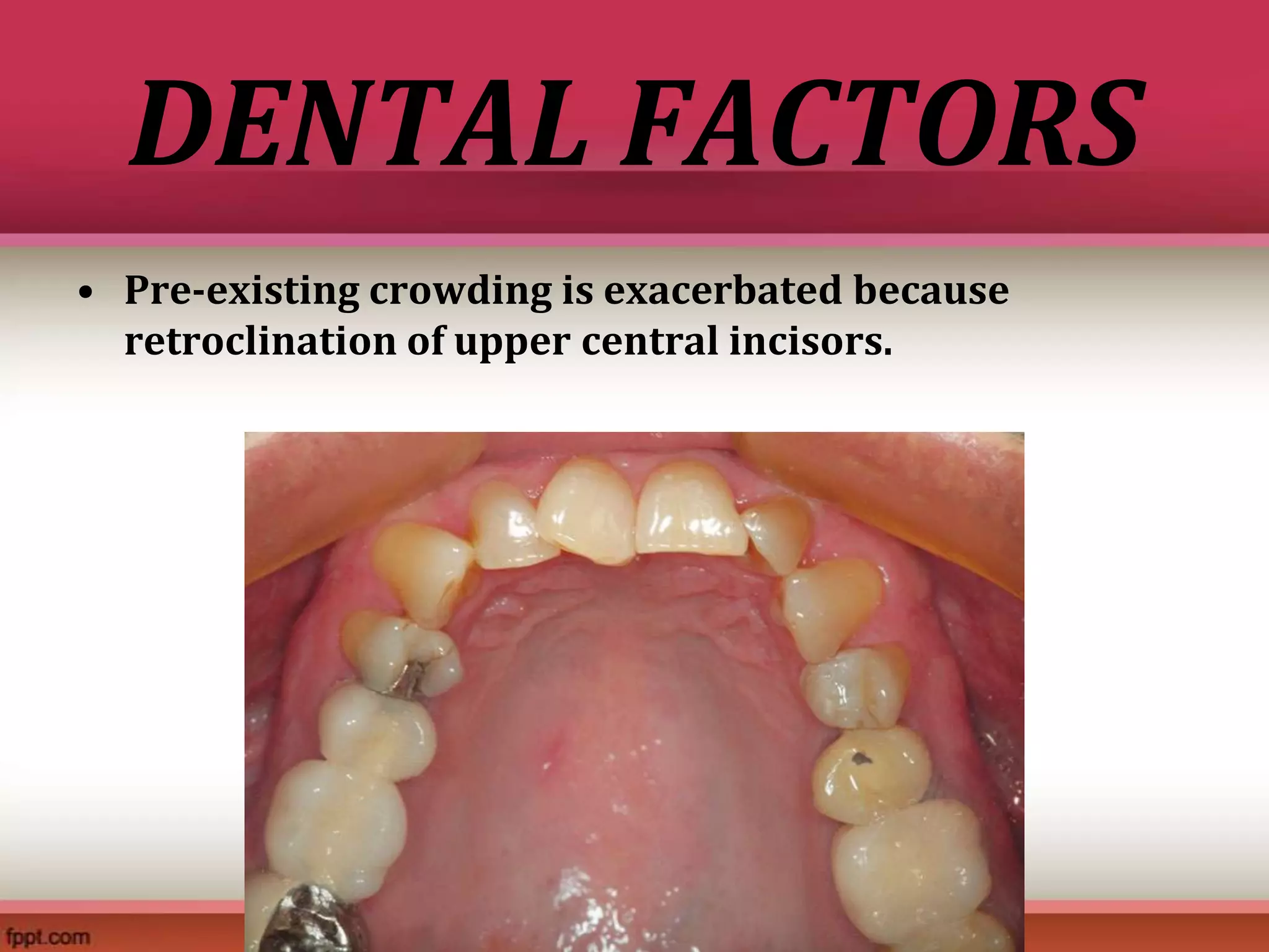 Treatment of class ii malocclusions | PPTX