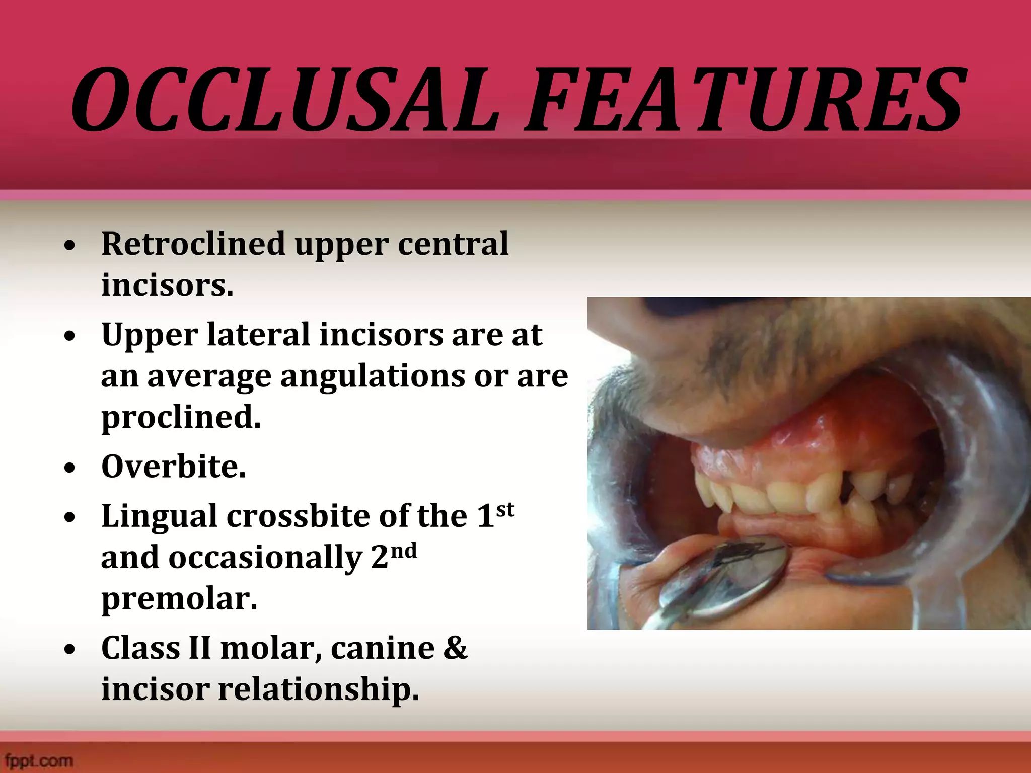 Treatment of class ii malocclusions | PPTX