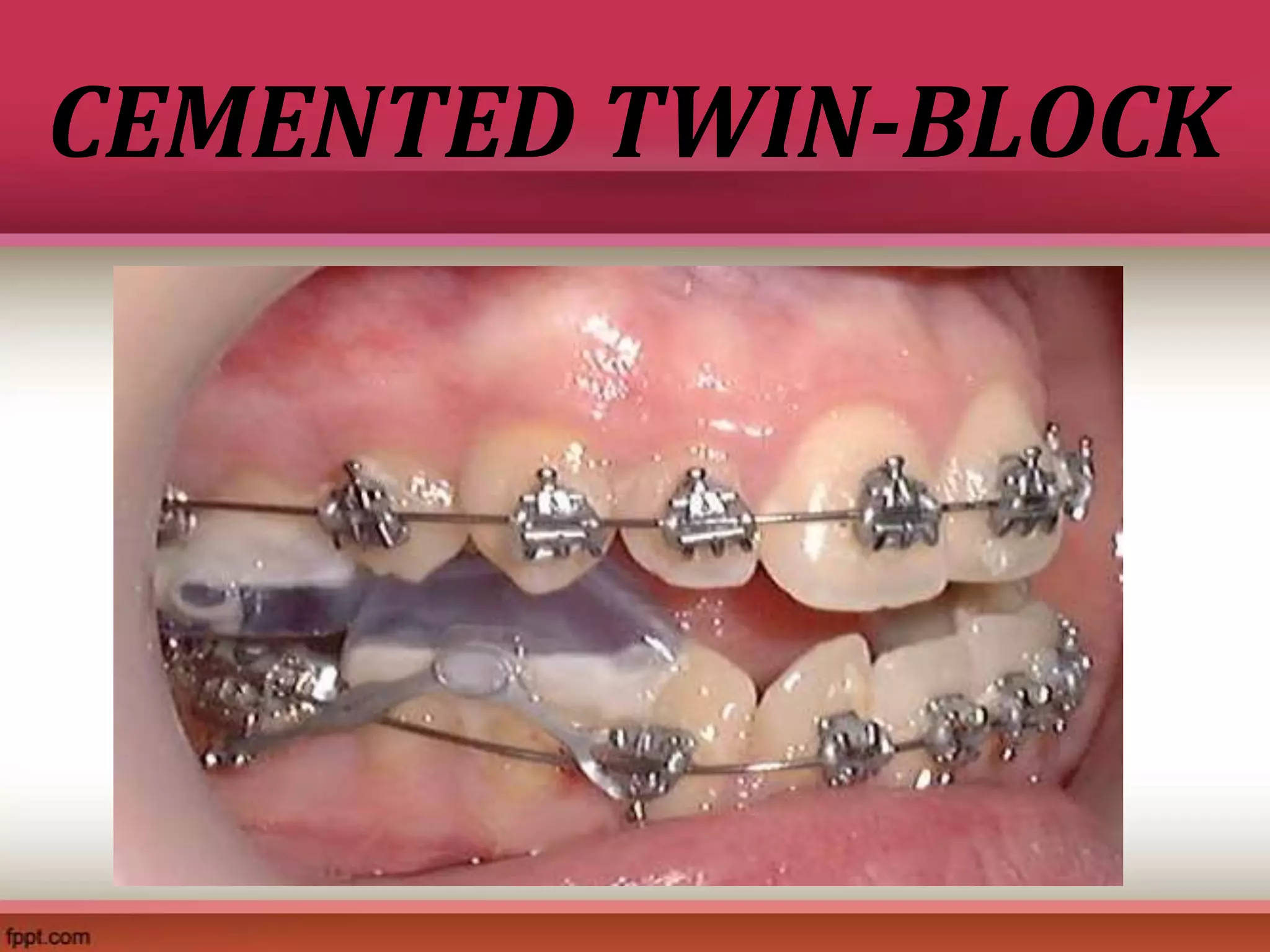 Treatment of class ii malocclusions | PPTX