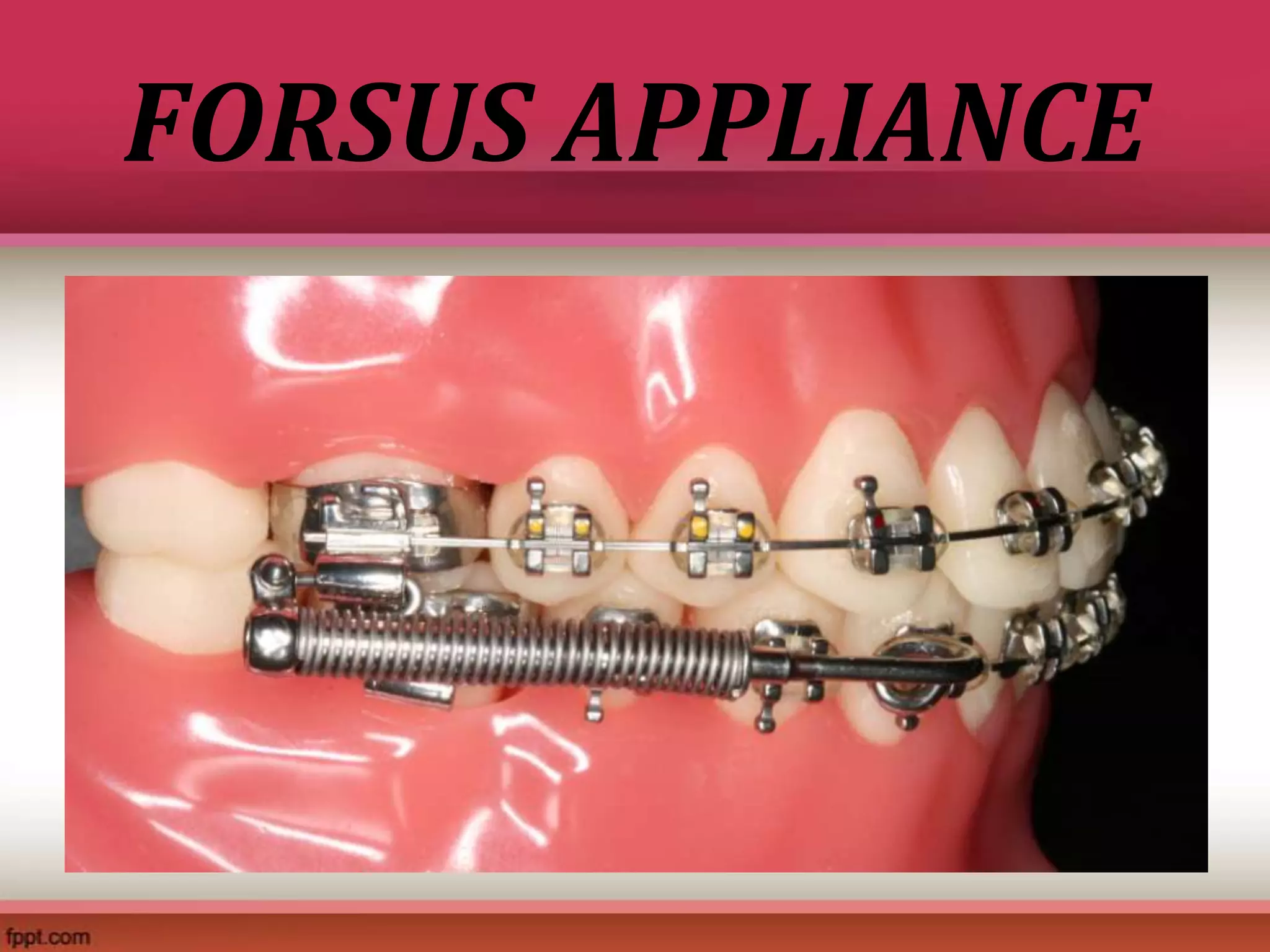 Treatment of class ii malocclusions | PPTX