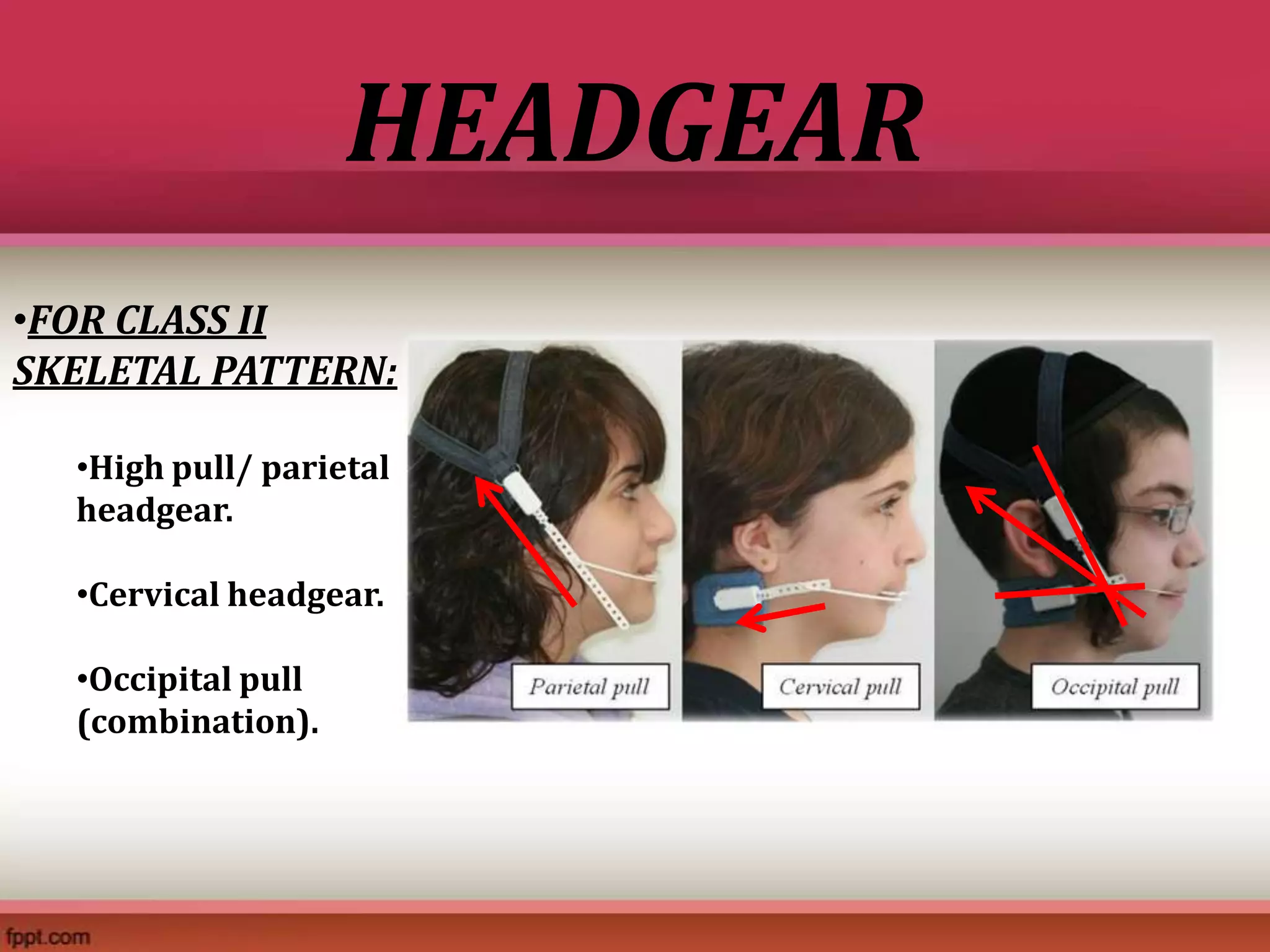 Treatment of class ii malocclusions | PPTX
