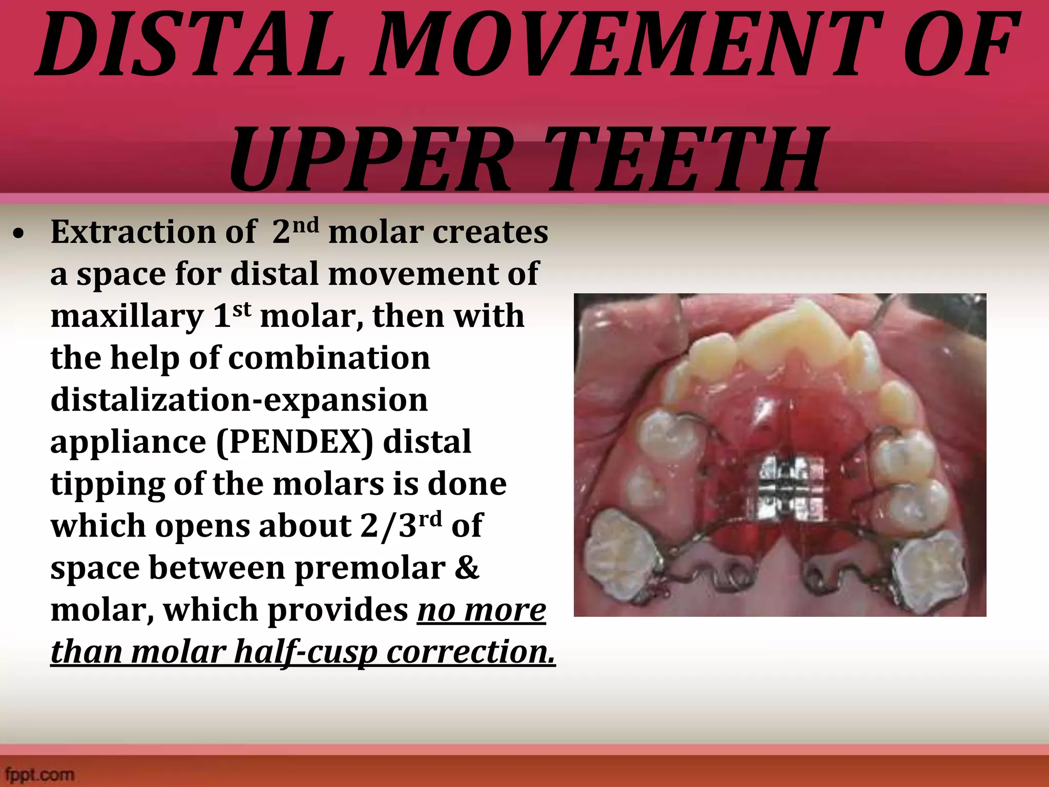 Treatment of class ii malocclusions | PPTX