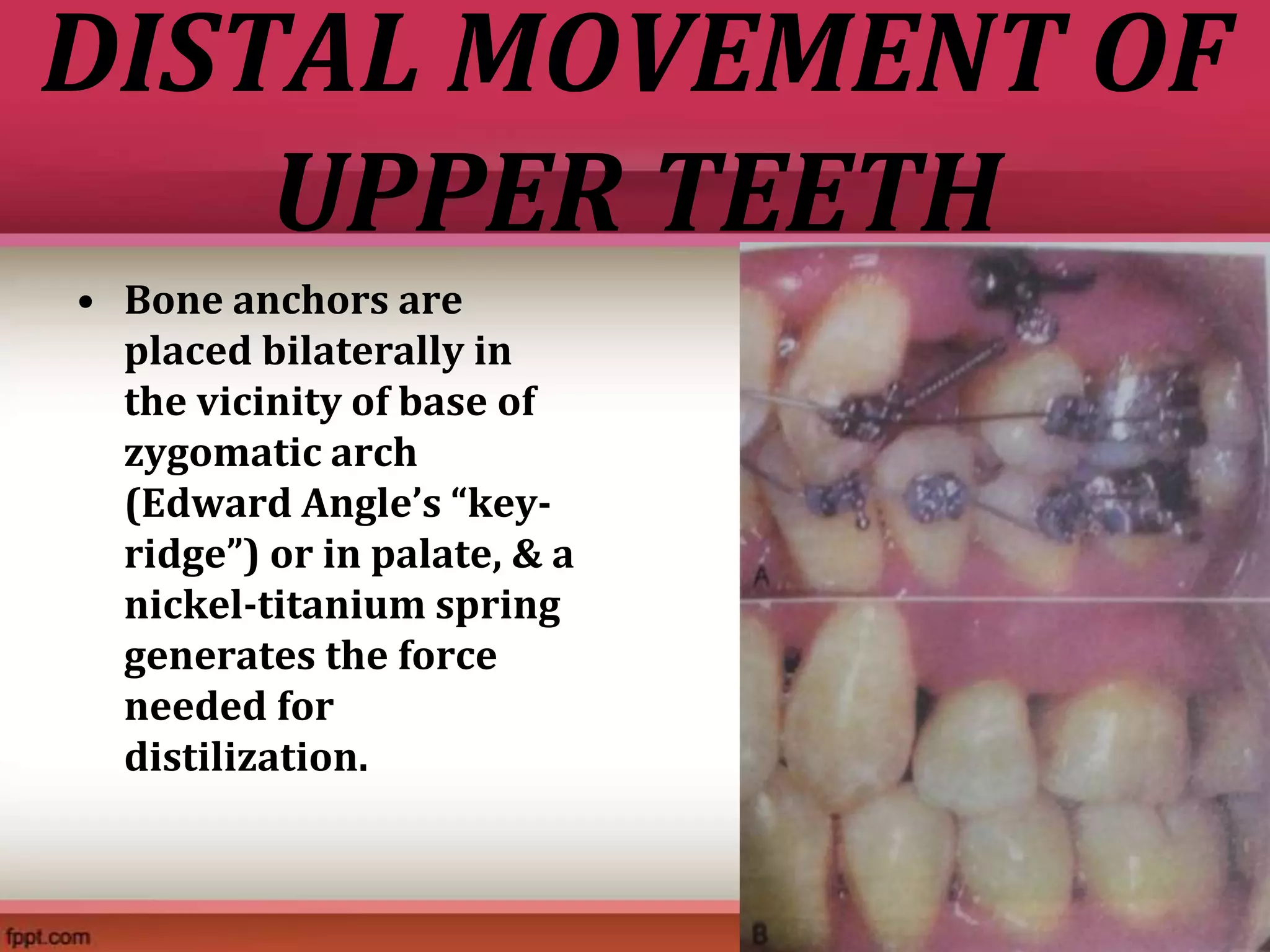 Treatment Of Class Ii Malocclusions Ppt