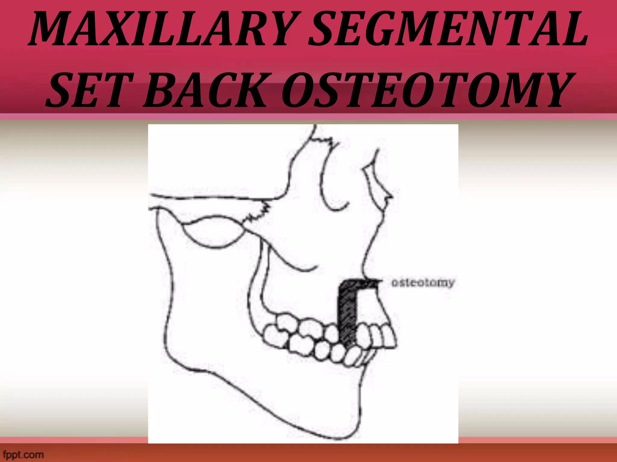 Treatment of class ii malocclusions | PPTX