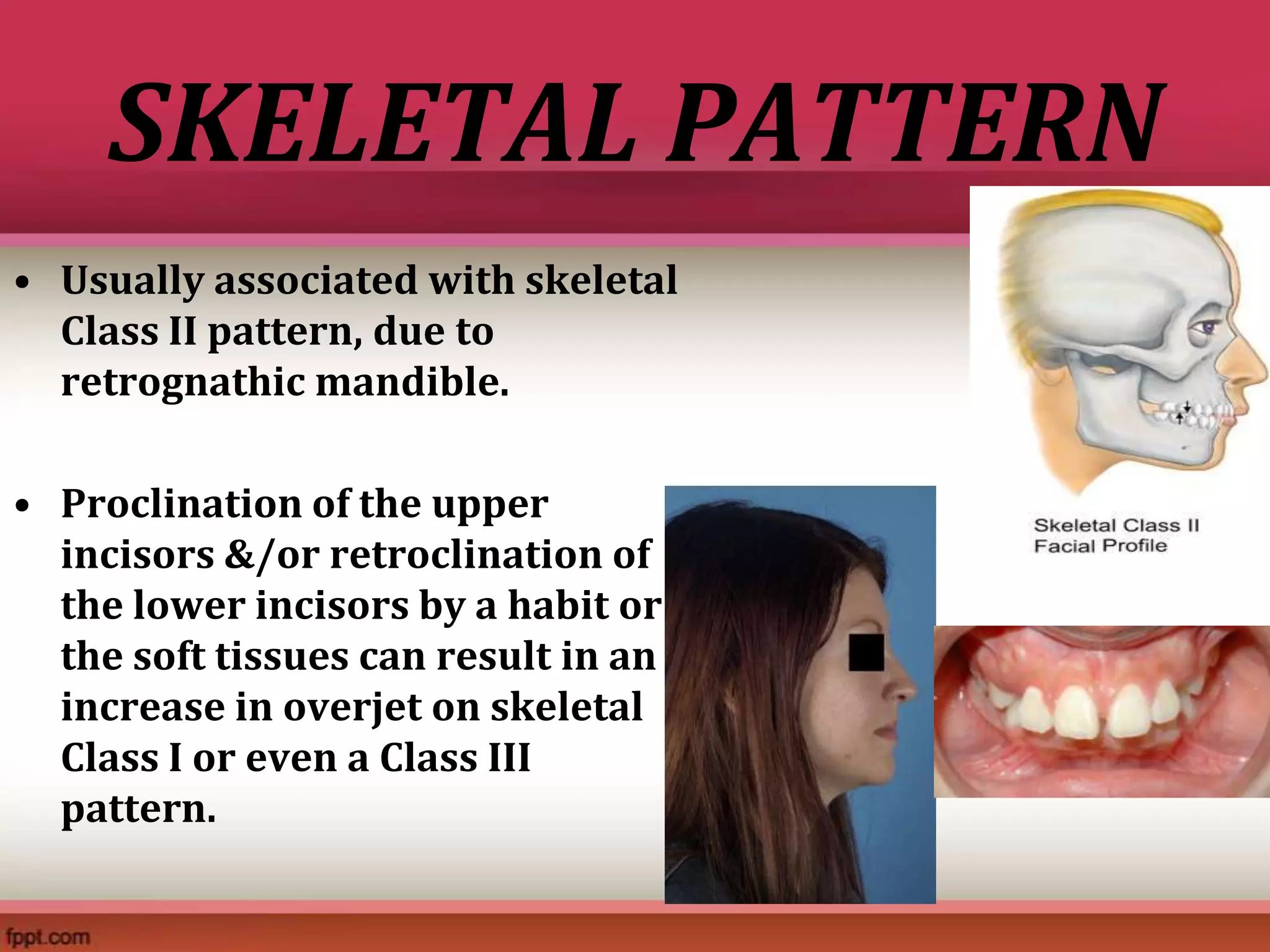 Treatment of class ii malocclusions | PPTX