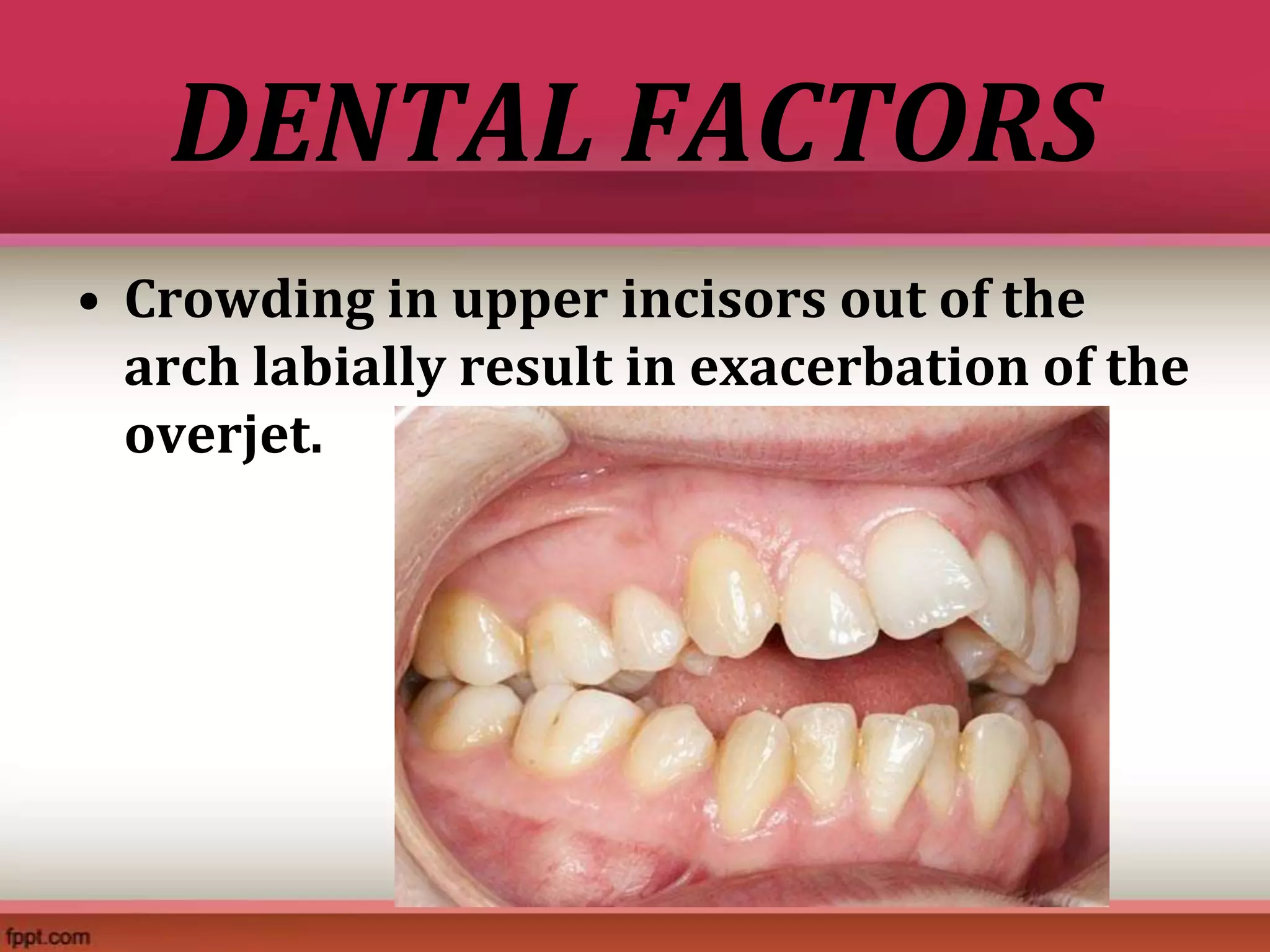 Treatment of class ii malocclusions | PPTX