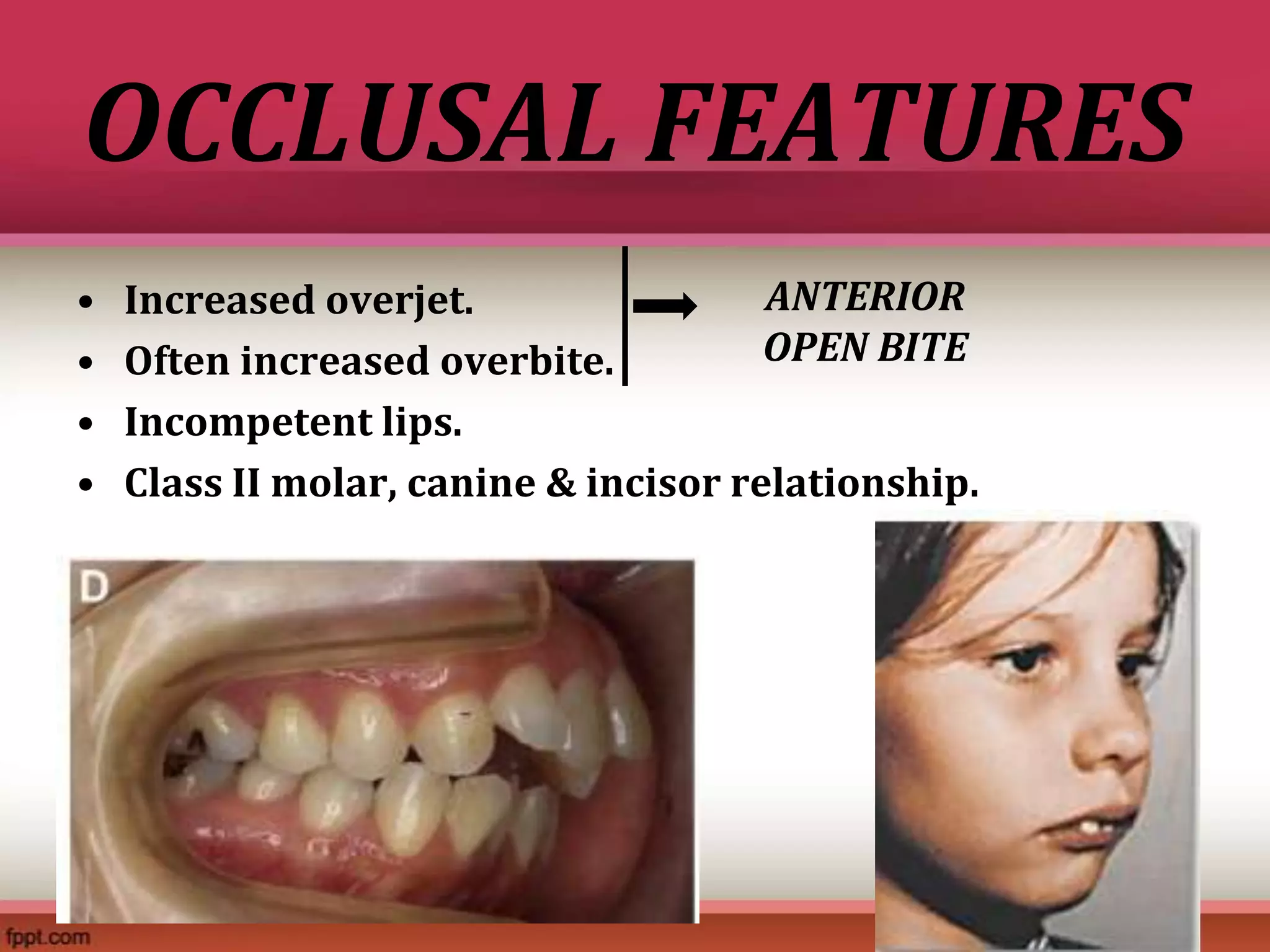 Treatment of class ii malocclusions | PPTX