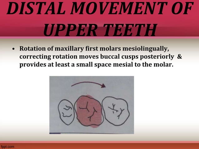 Treatment of class ii malocclusions | PPTX