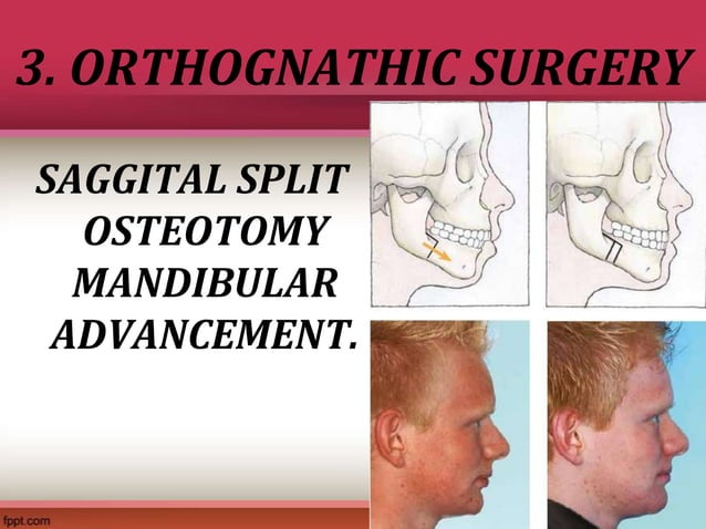 Treatment of class ii malocclusions | PPTX