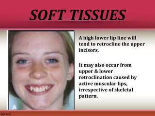 Treatment of class ii malocclusions | PPT