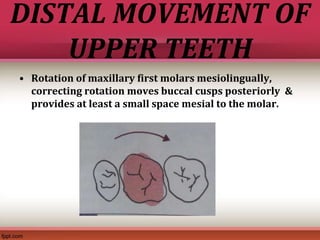 Treatment of class ii malocclusions | PPT