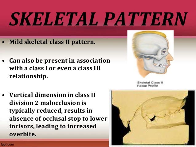 Treatment of class ii malocclusions