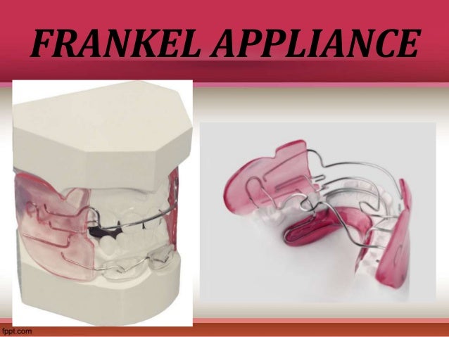 Treatment of class ii malocclusions
