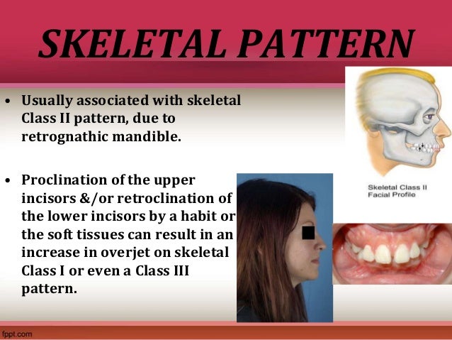 Treatment Of Class Ii Malocclusions
