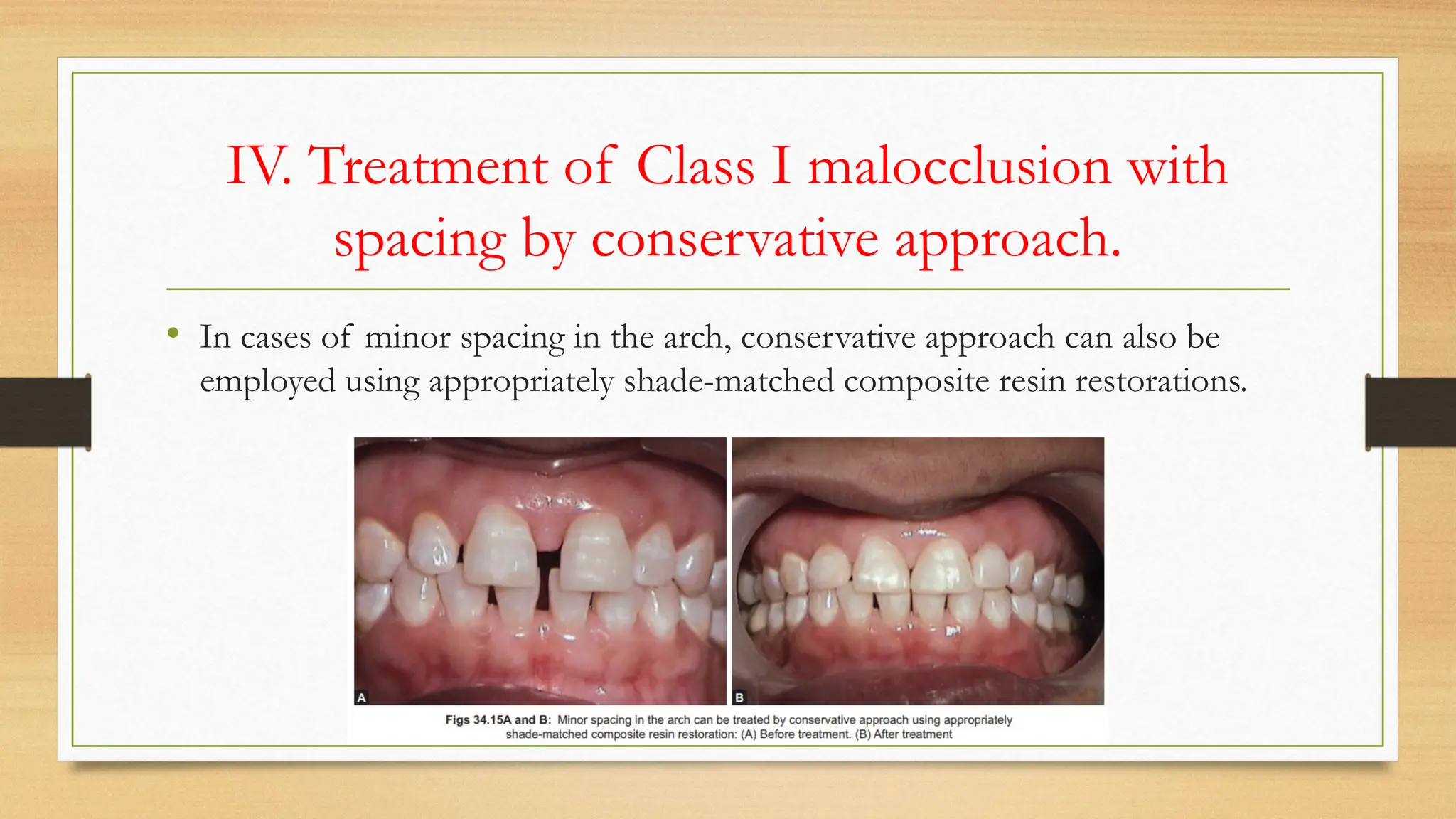 Treatment of Class I Malocclusion .pptx