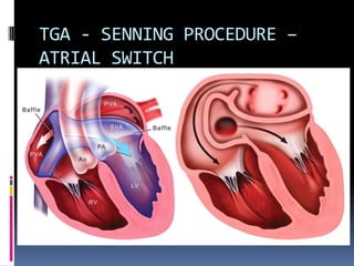 Treatment of congenital heart disease | PPTX