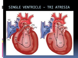 Treatment of congenital heart disease | PPTX