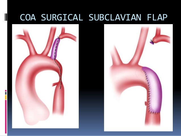 Treatment of congenital heart disease