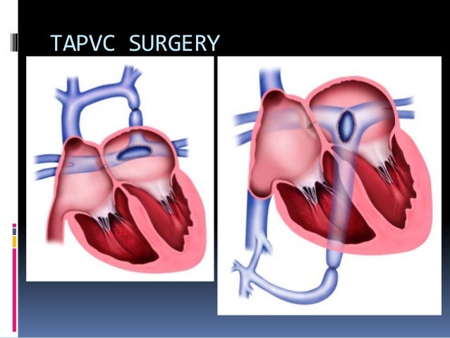 Treatment of congenital heart disease