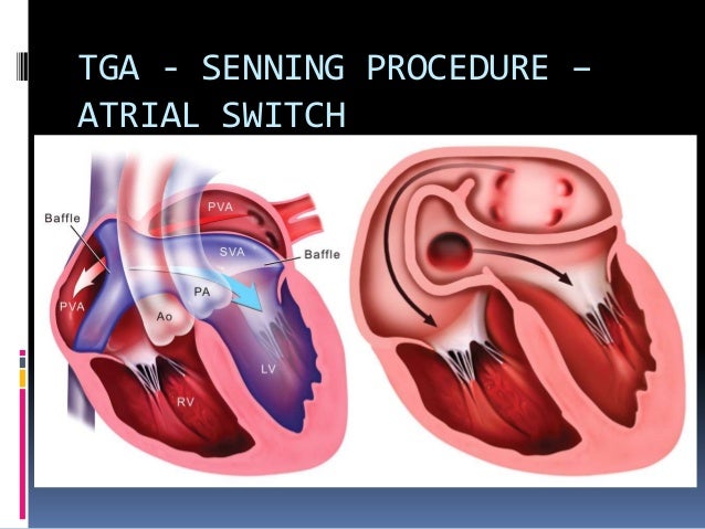 Treatment of congenital heart disease
