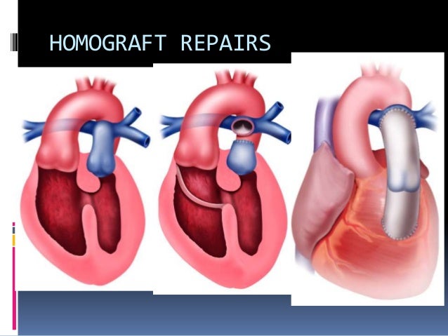 Treatment of congenital heart disease