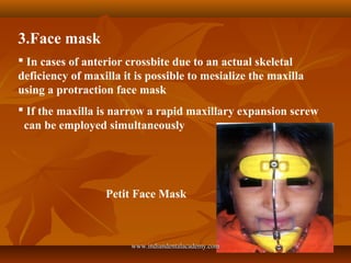 Treatment of crossbite /certified fixed orthodontic courses by Indian ...