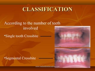 Treatment of crossbite /certified fixed orthodontic courses by Indian ...
