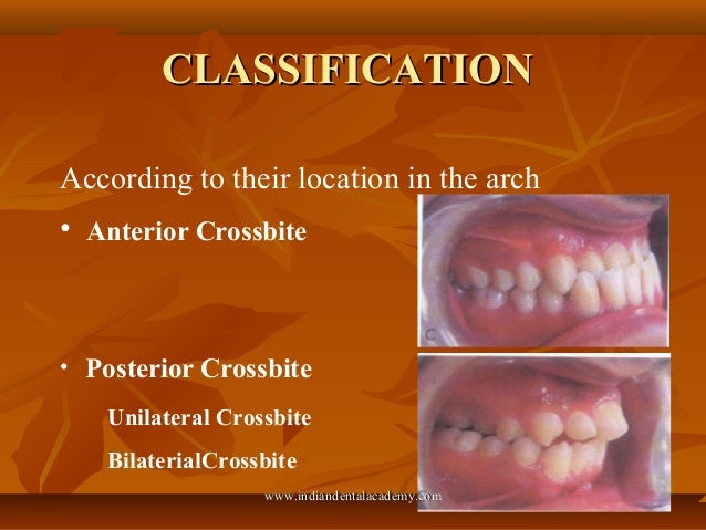Treatment of crossbite /certified fixed orthodontic courses by Indi…