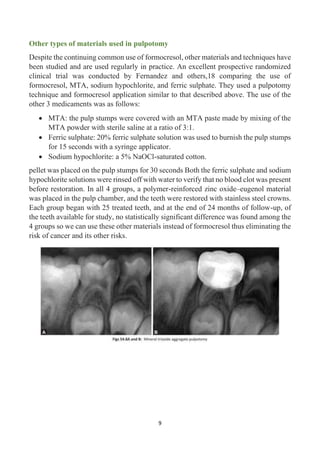 Treatment of deep caries and pulp exposure | PDF