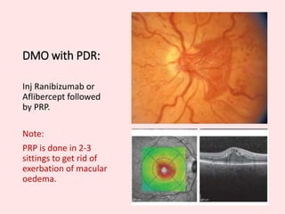Treatment of Diabetic Retinopathy.pptx