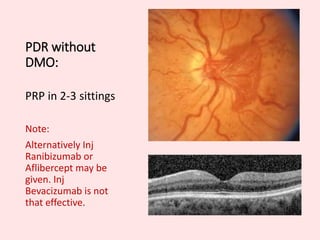 Treatment of Diabetic Retinopathy.pptx